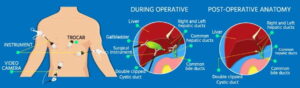 Cholecystectomy - Open & Laparoscopic Procedures | Dr Michael Chu
